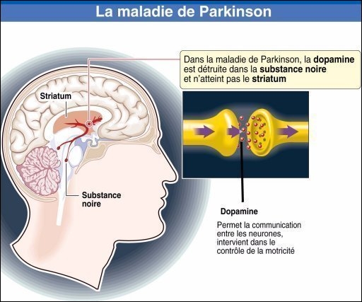 Maladie de Parkinson Maladie de Parkinson