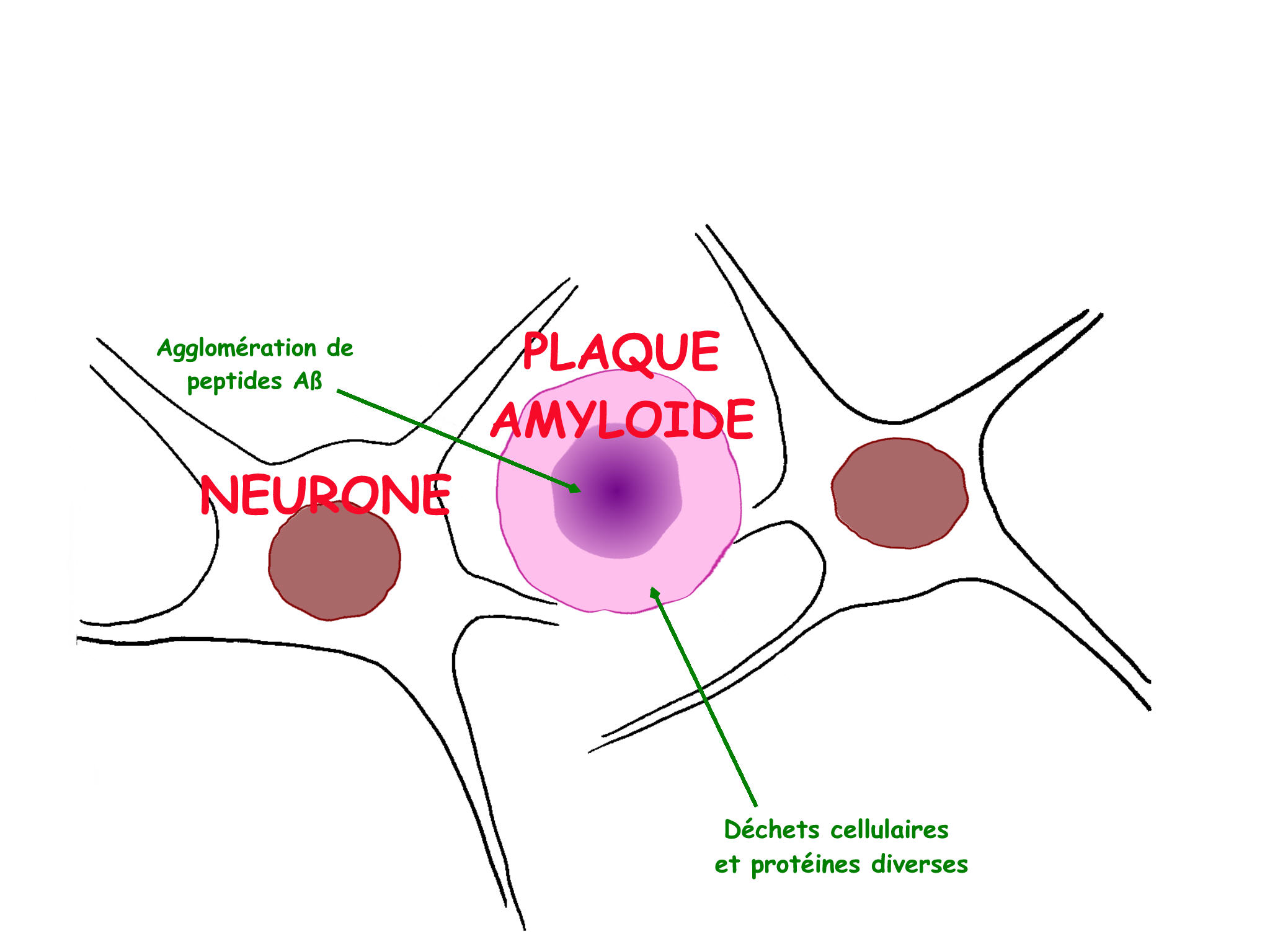 Beta-Amyloid Plaques Definition at Michael Brehm blog